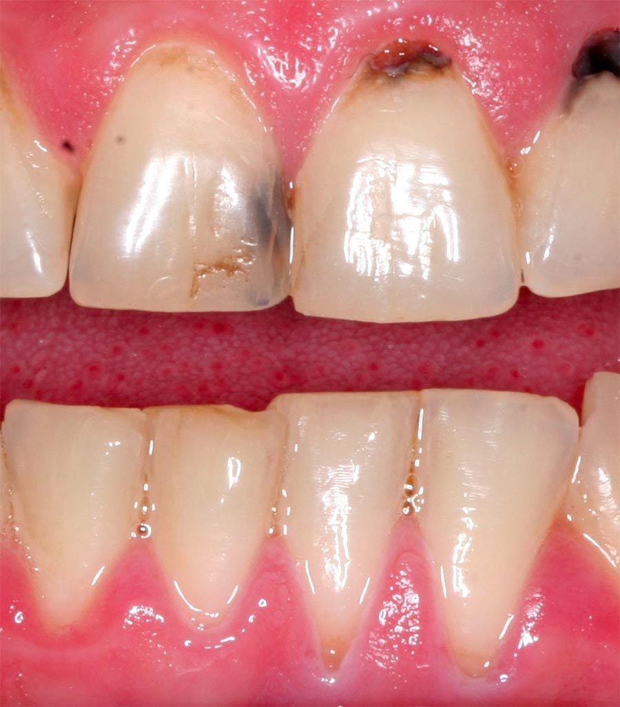 16 Ways You Didn't Know You Were Damaging Your Teeth - RVCJ Media