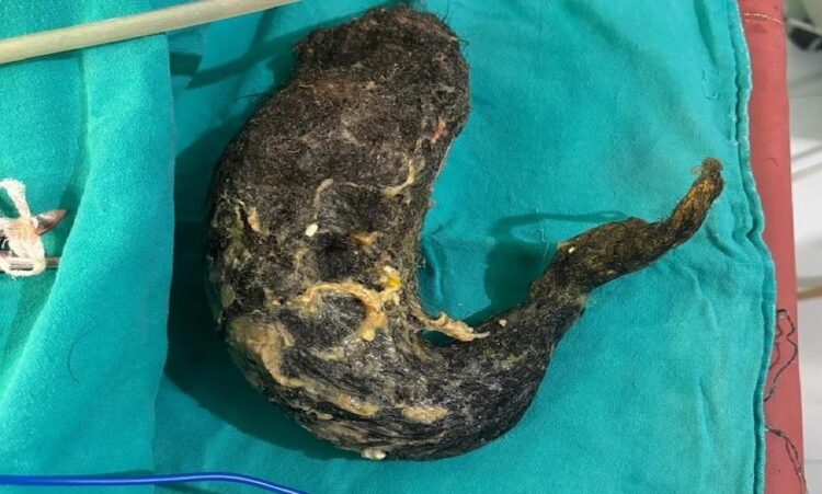 2 Kg Of Hair Found In Stomach Of Woman In UP, Doctors Revealed Her ...